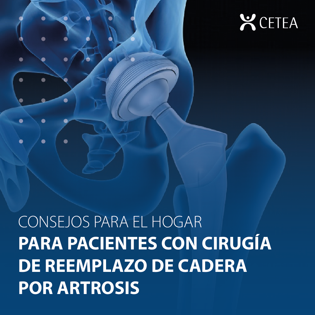 Recomendaciones en el hogar para pacientes con cirugía de reemplazo de ...